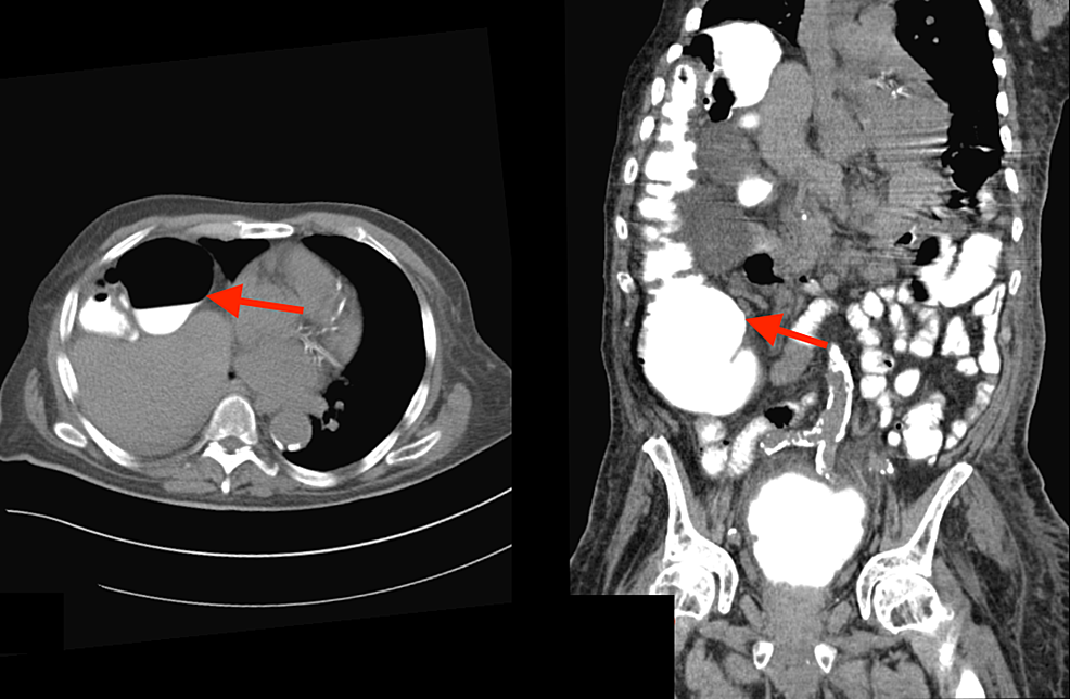 Chilaiditi's Sign Associated with Acute Colonic Pseudo-obstruction: A ...