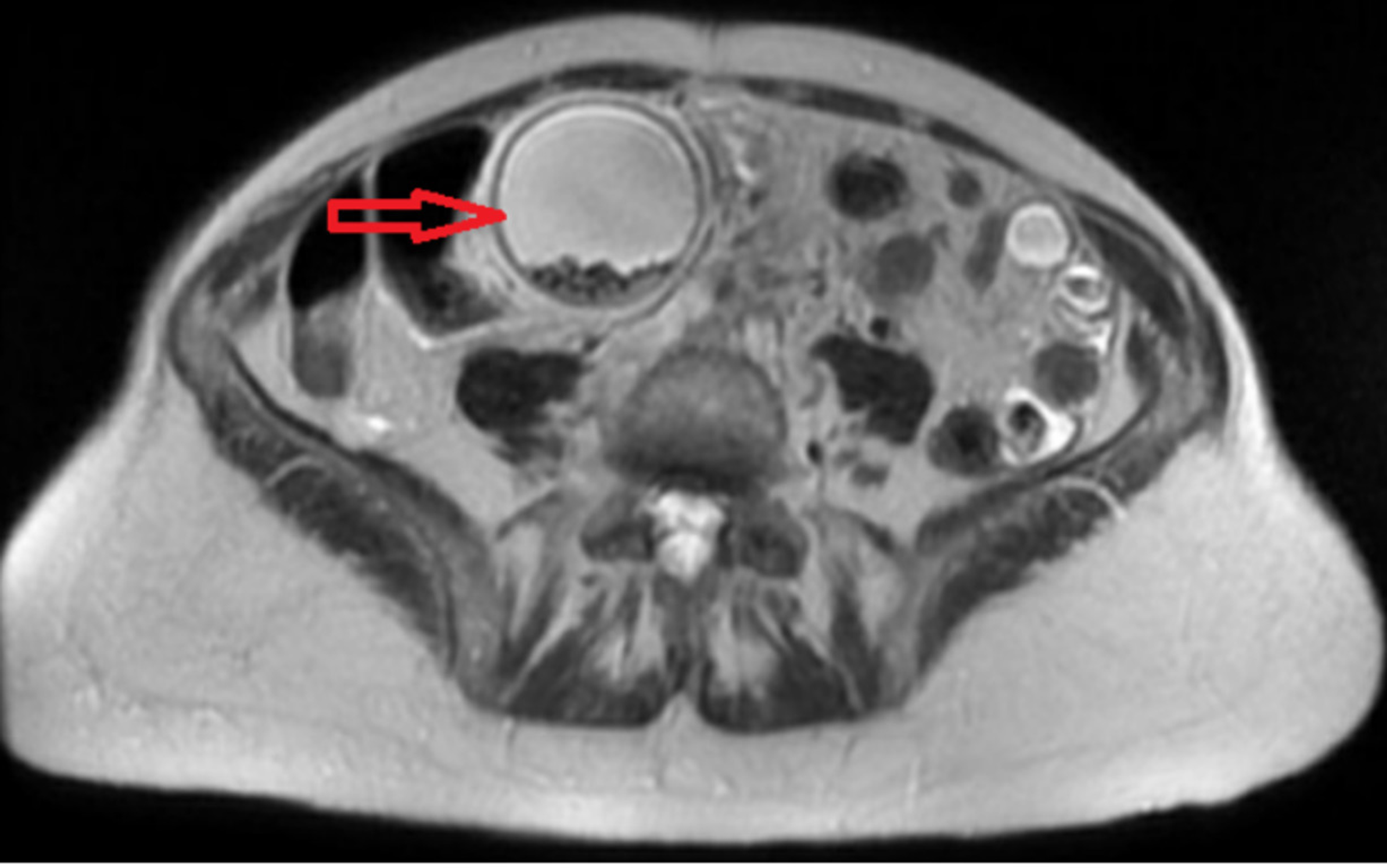 Cureus | A Rare Case of Acute Calculous Cholecystitis With Gallbladder ...
