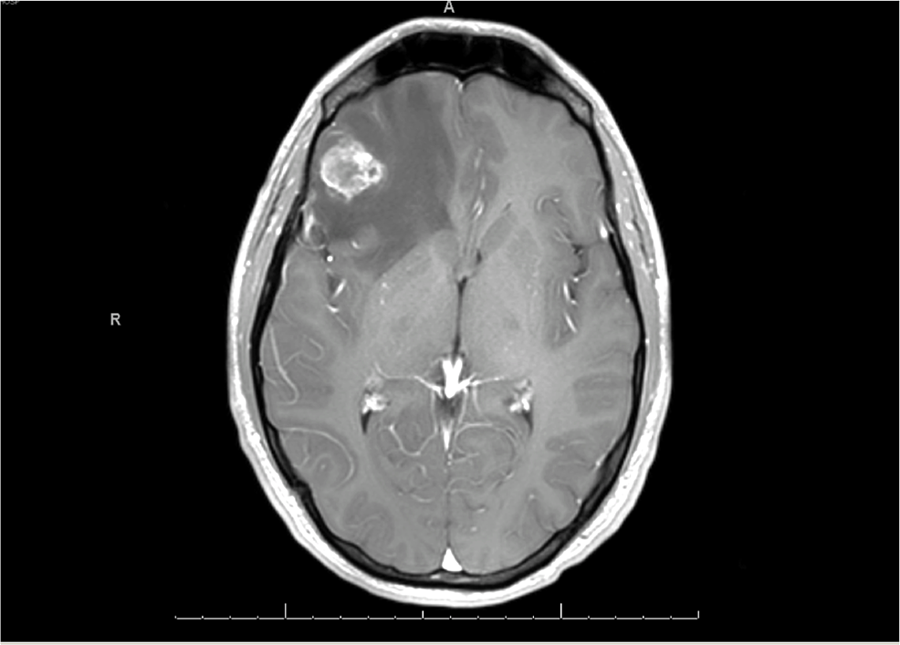 Cureus Brain Metastases As Presenting Feature In Burned Out Cureus Brain Metastases As Presenting Feature In Burned Out
