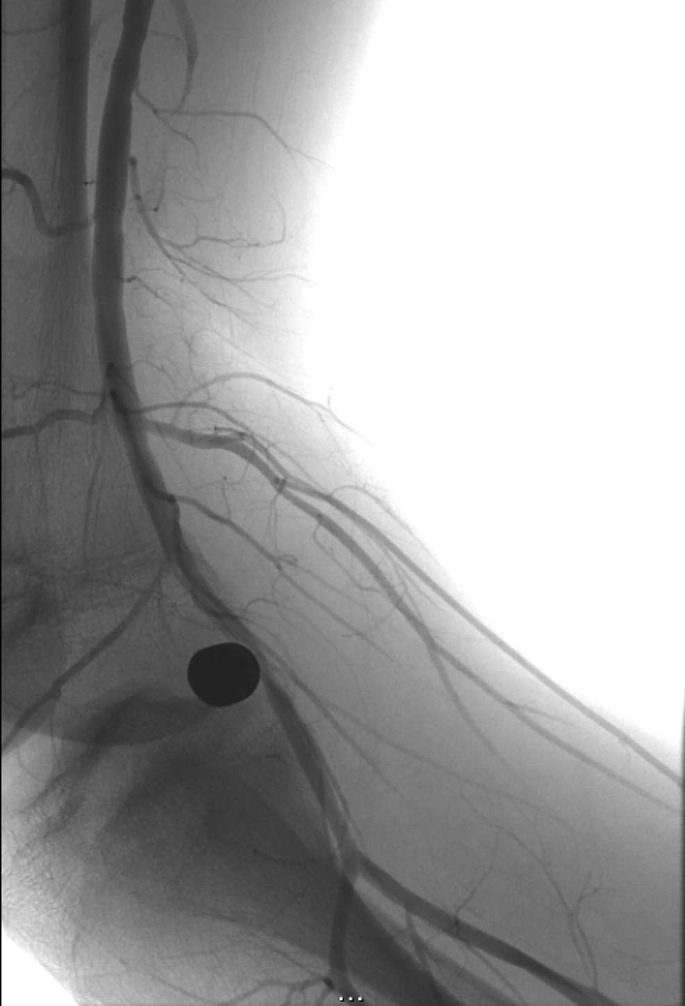 Cureus A Rare Case Of Dynamic Popliteal Artery Occlusion After cureus-a-rare-case-of-dynamic-popliteal-artery-occlusion-after