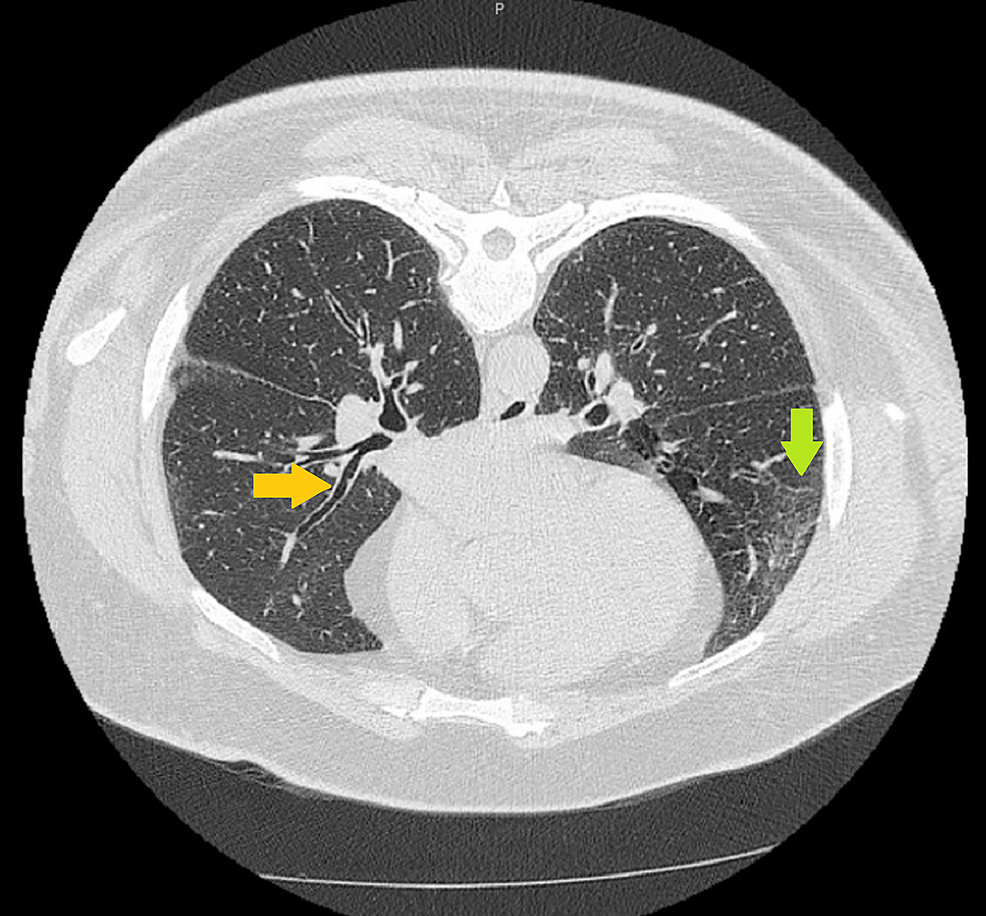 Cureus Testicular Sarcoidosis An Underdiagnosed Manifestation That