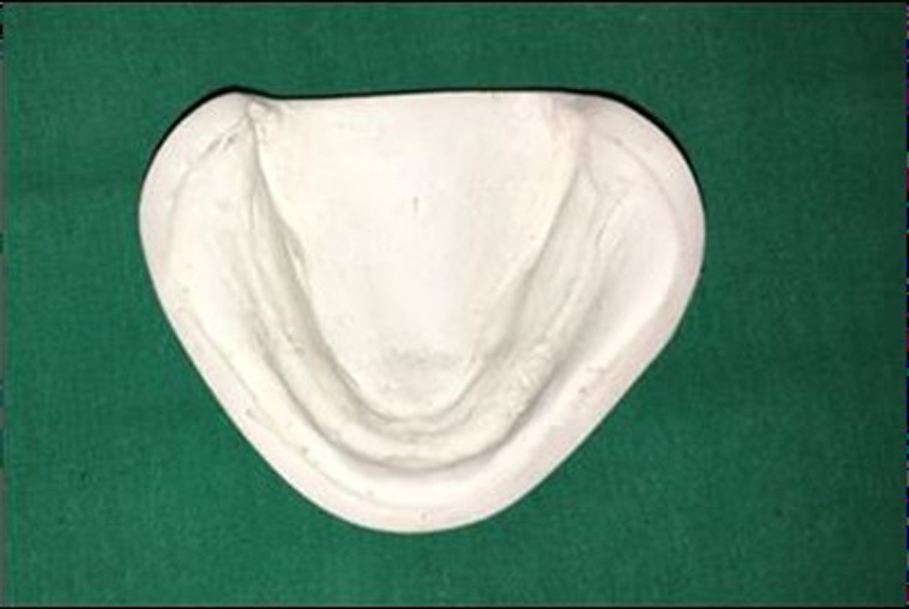 Cureus | Microstrain Analysis of Selective Pressure Techniques for ...