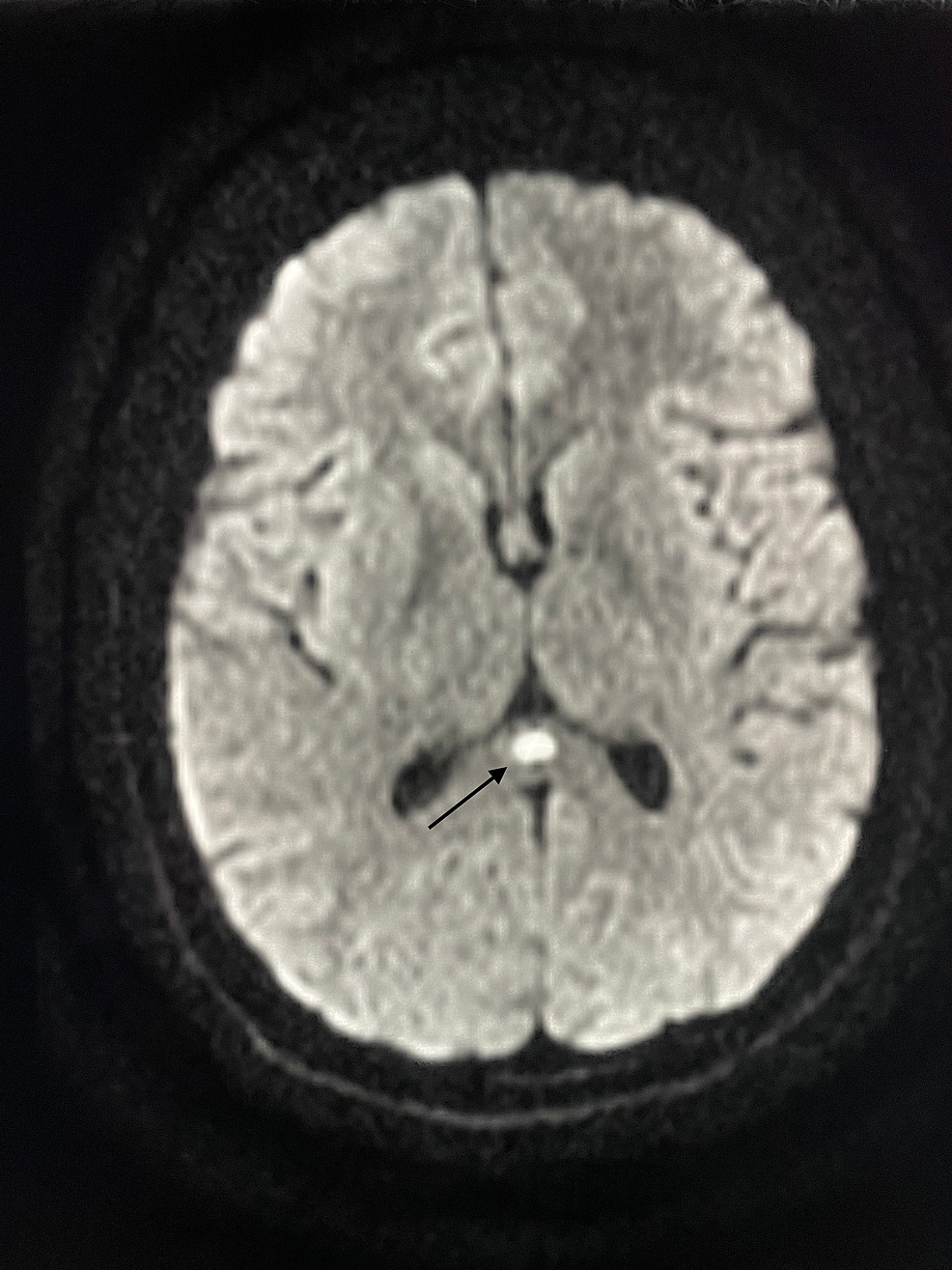 Corpus Callosum Infarct
