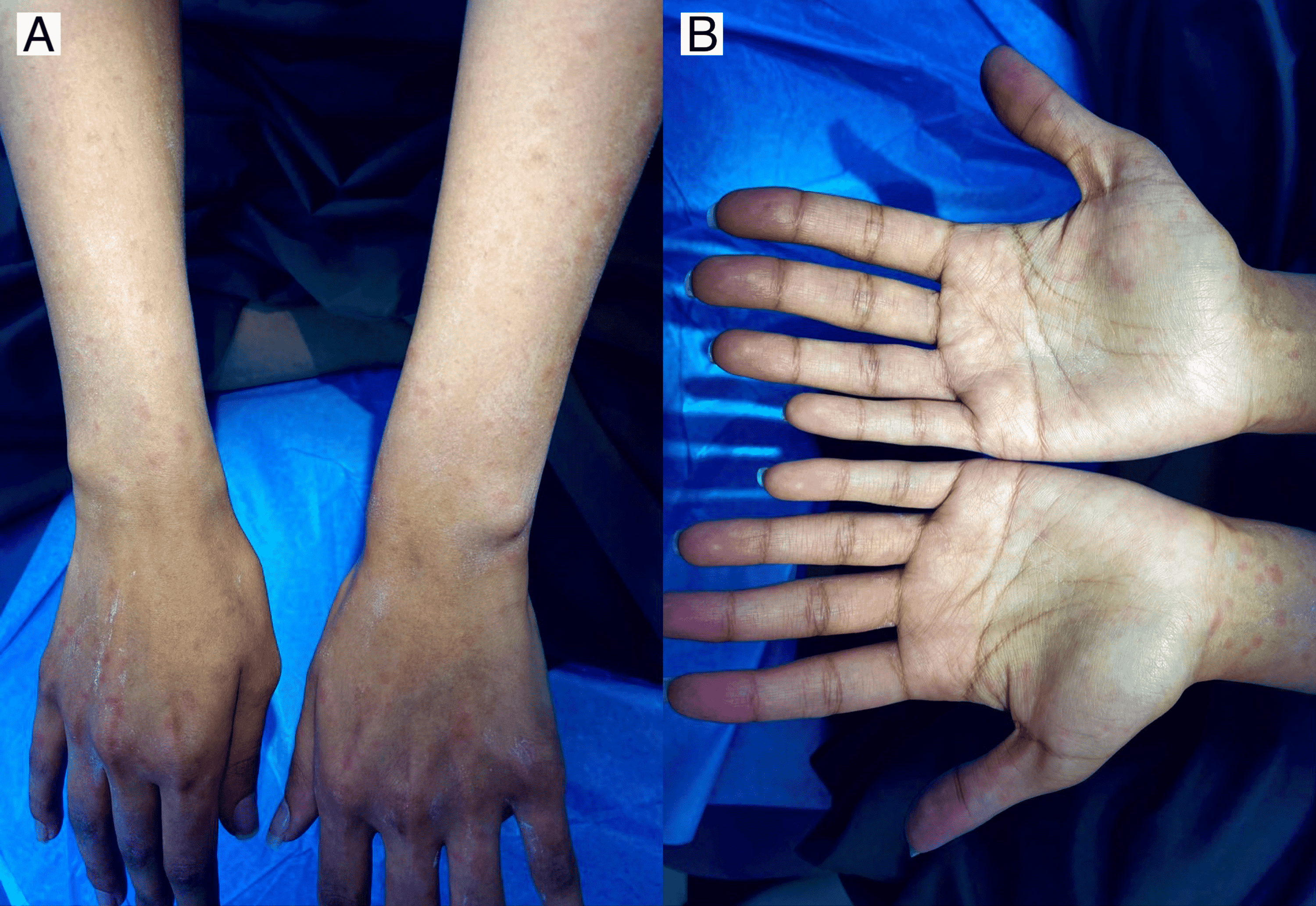 Morbilliform Eruption After Administration of Second Dose of Oxford ...