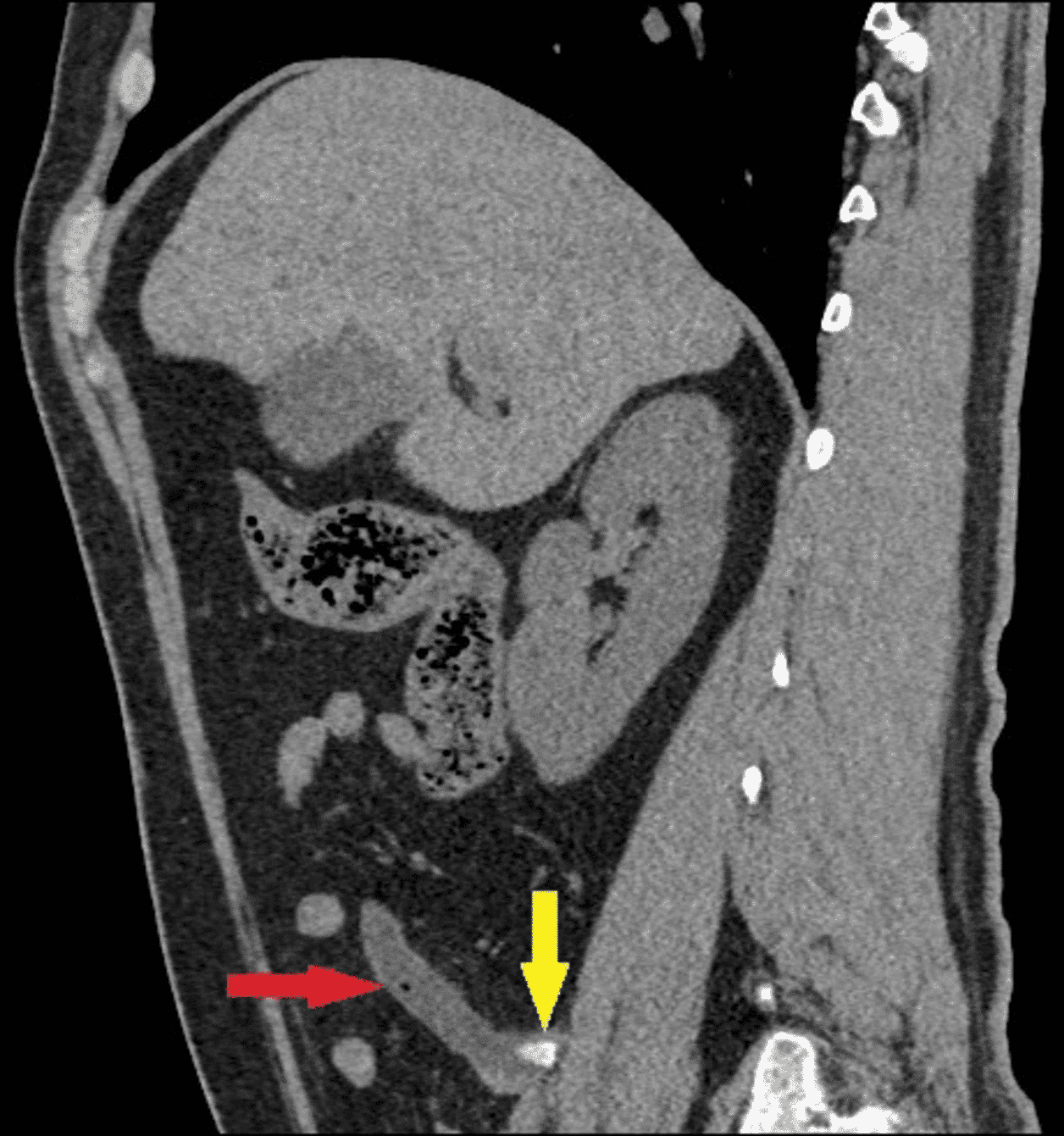 Superinfection Of An Obstructive Appendiceal Mucocele A Case Report