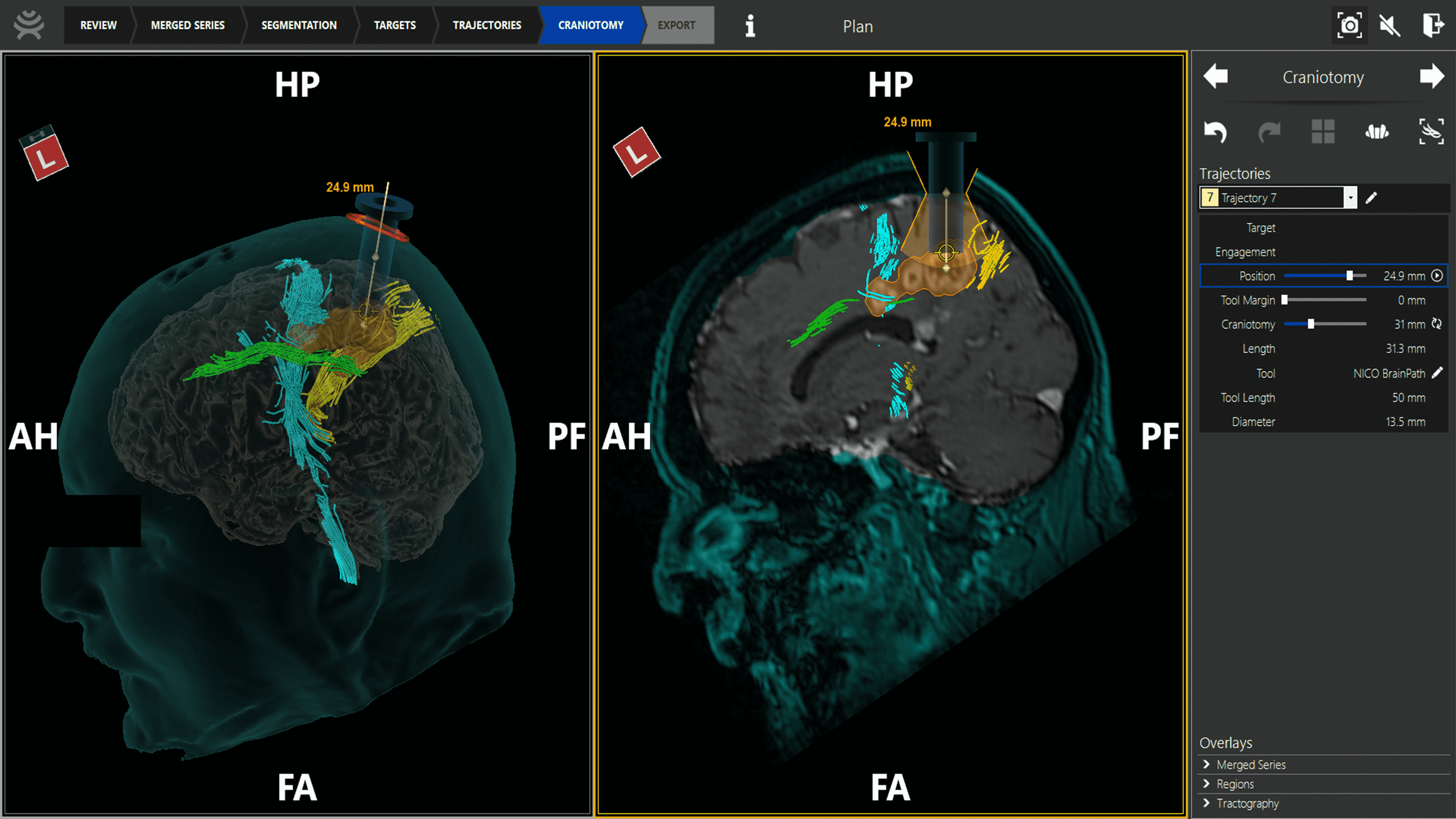 Cureus | Comparative Quantification of Diffusion Tensor Tractography ...