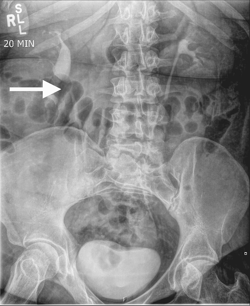 Cureus | Unilateral Cystic Kidney Disease in a Young Female