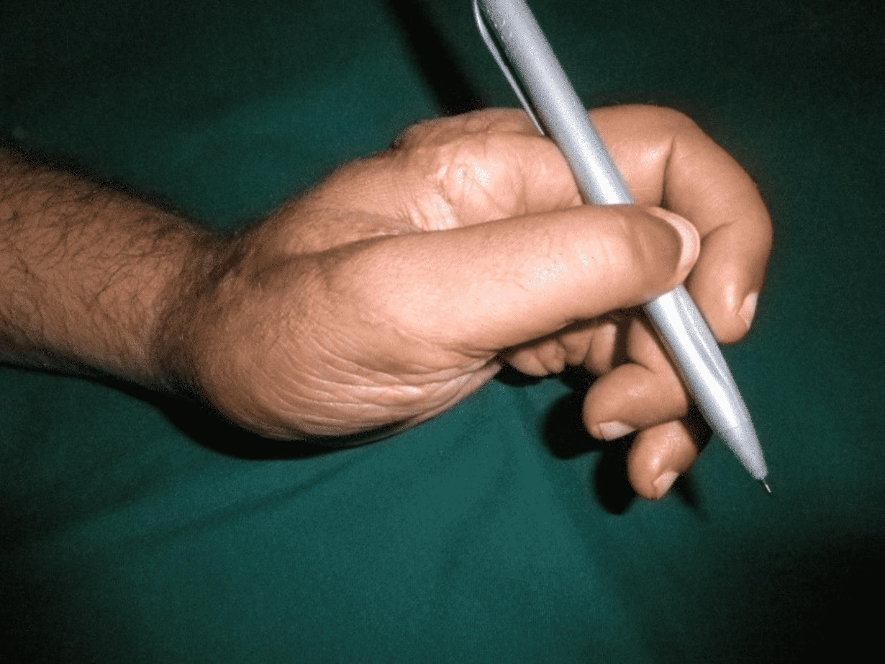 Two-Stage Cross-Hand Transfer: A Case Report | Cureus