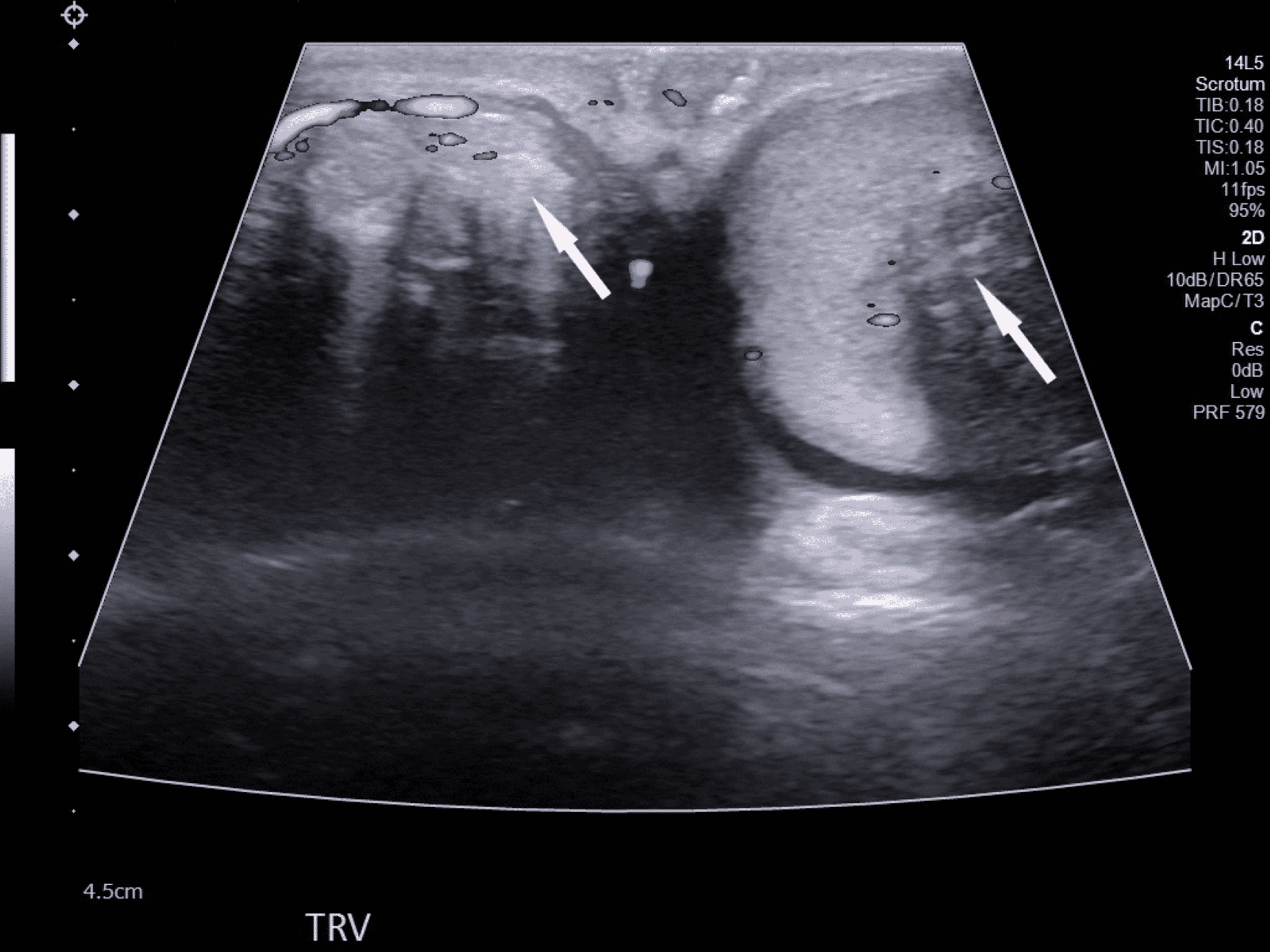 Cureus Testicular Adrenal Rest Tumors In A Patient With Congenital