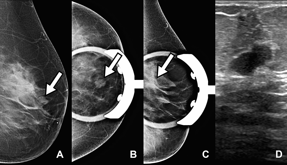 Cureus Postmenopausal Tubular Adenoma Of The Breast A Case Report