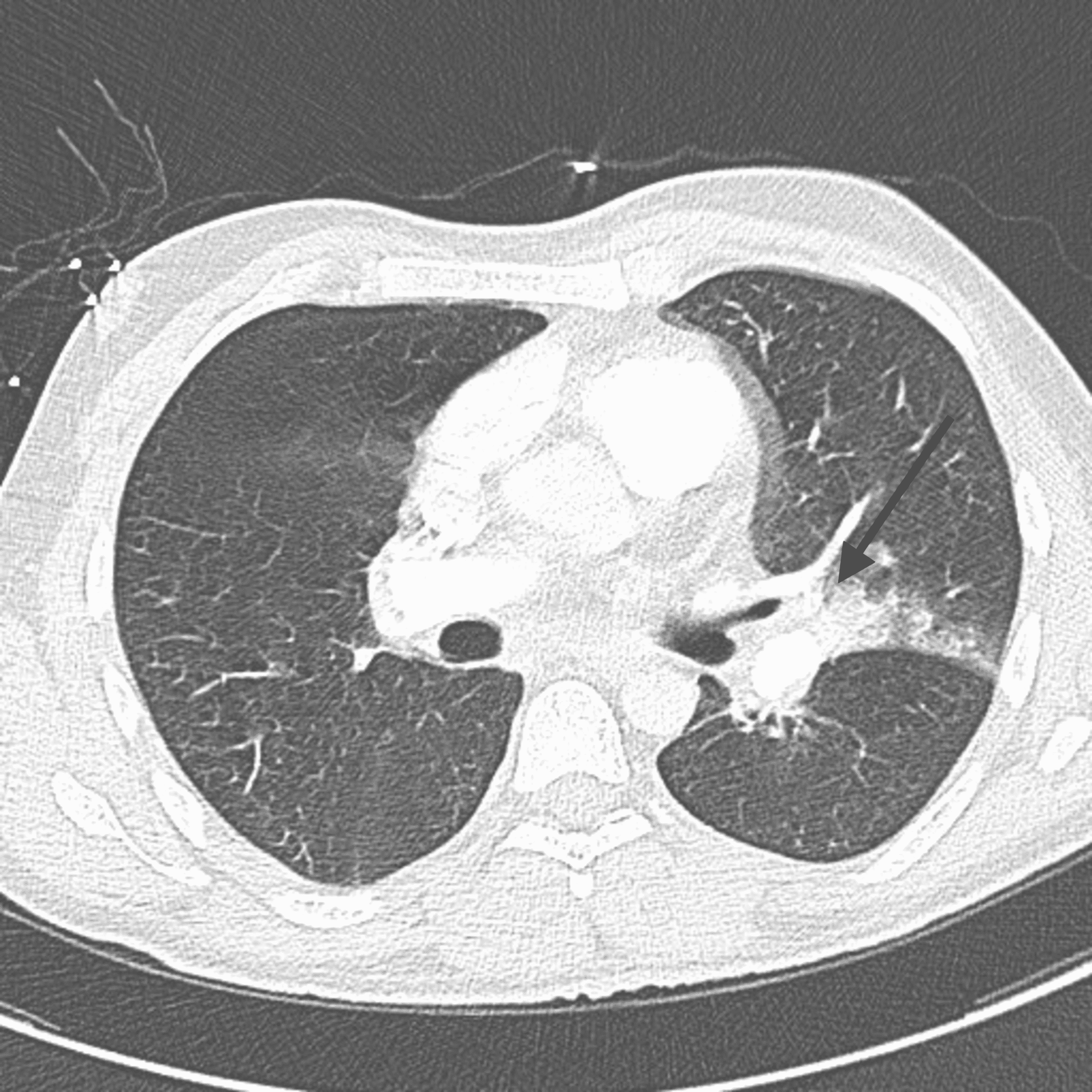 Cureus Inhaled Nitric Oxide Ino With A Massive Pulmonary Embolism