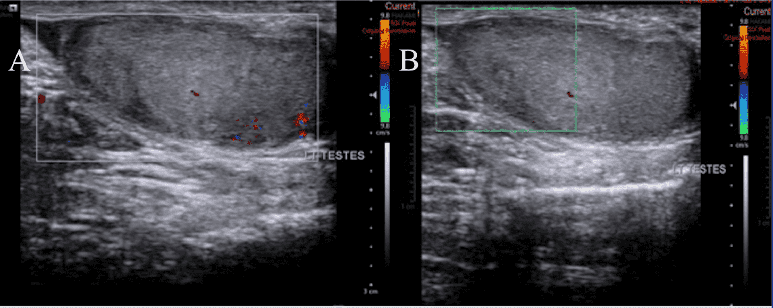 Cureus Segmental Testicular Infarction A Case Report