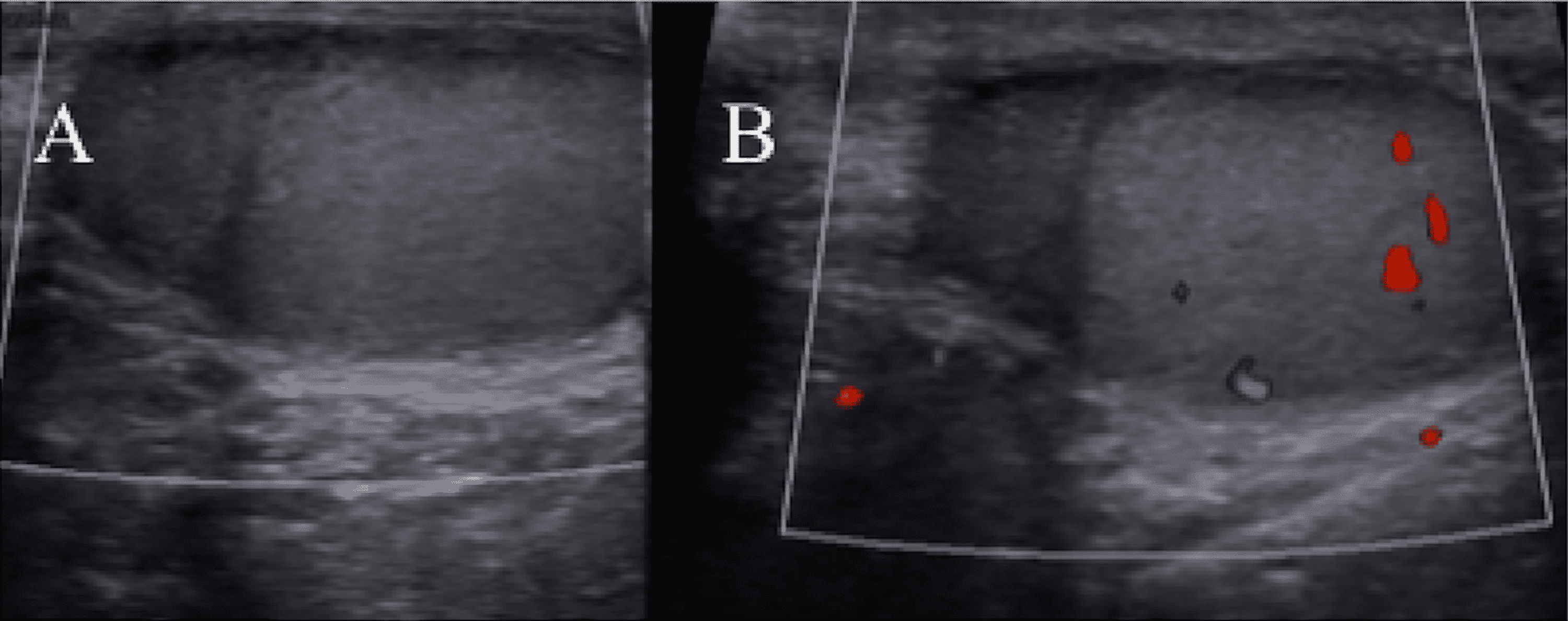 Cureus Segmental Testicular Infarction A Case Report