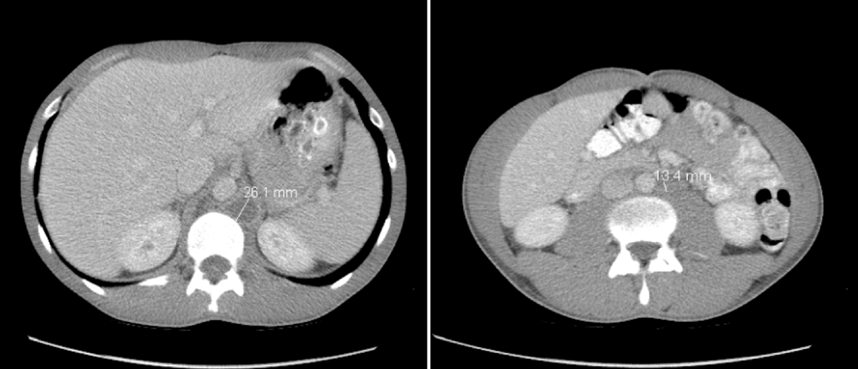 Cureus | Burned-Out Testicular Germ Cell Tumor Presenting as ...