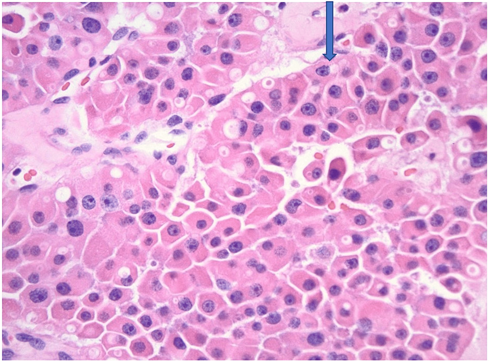 Oncocytic Cell Carcinoma of the Thyroid: A Case Report and an Overview ...