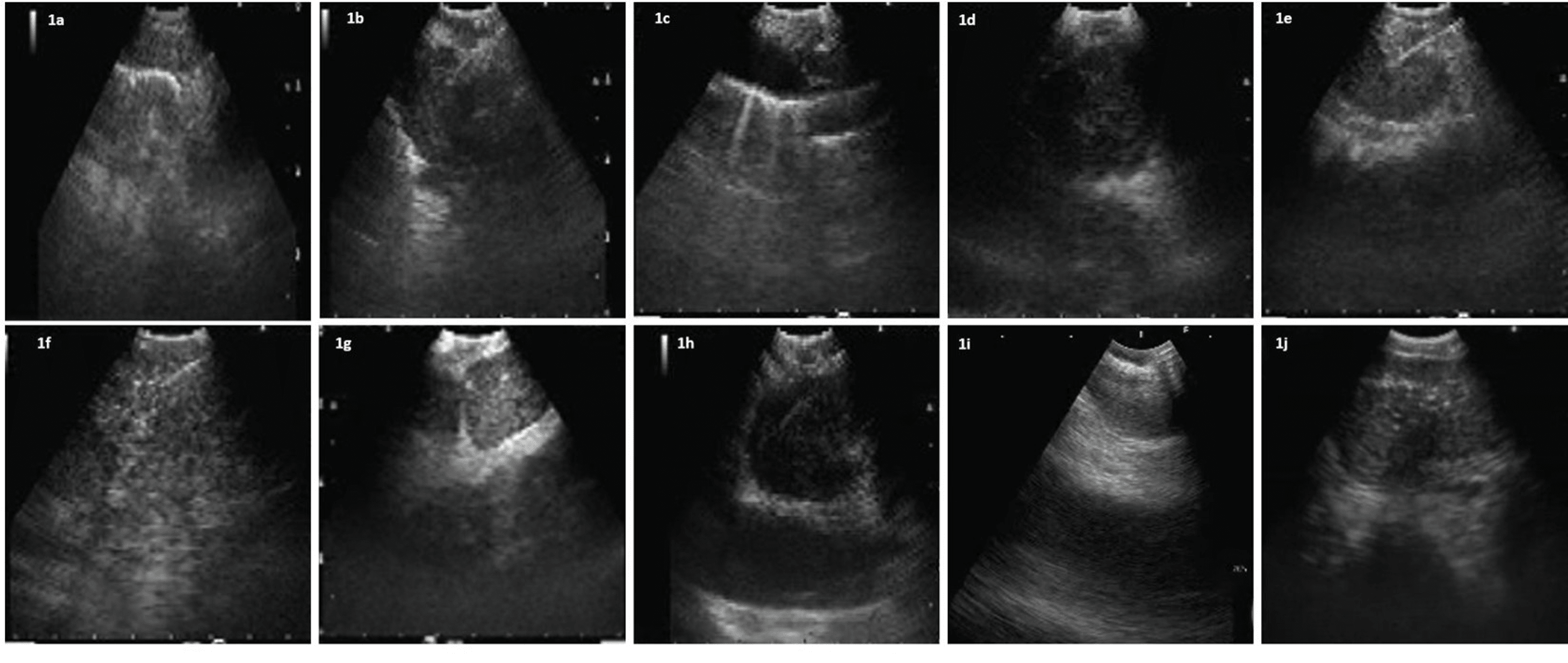 Cureus Correlating Ultrasonographic Features Of Lymph Nodes During