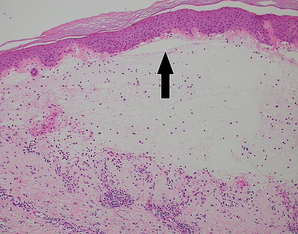 A Patient Develops Bullous Rash After Receiving the Second Dose of ...