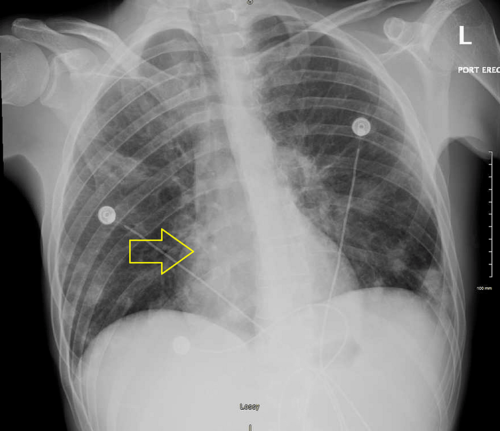 Cureus Mannitol Anaphylaxis In The Setting Of Septic Emboli Induced cureus-mannitol-anaphylaxis-in-the-setting-of-septic-emboli-induced