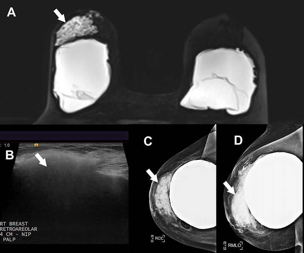 Cureus Free Silicone With Giant Cell Reaction Can Enhance On Breast MRI Cureus Free Silicone With Giant Cell Reaction Can Enhance On Breast MRI