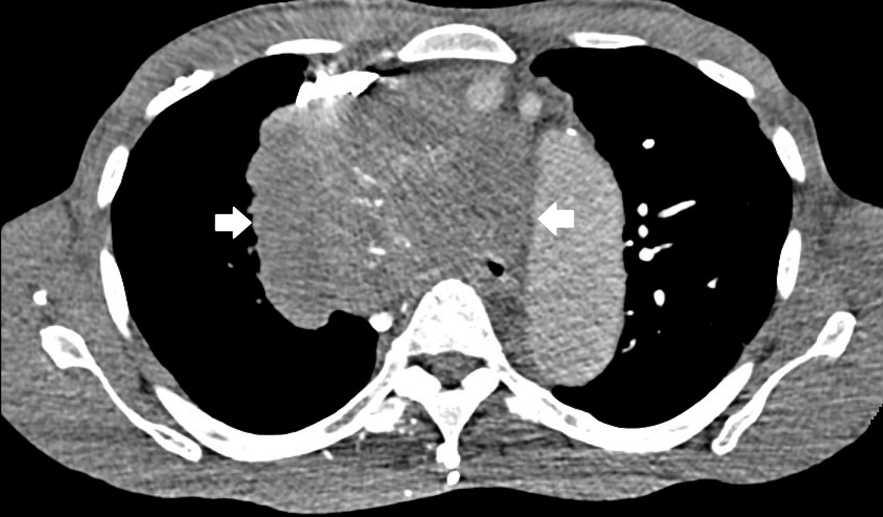 Cureus Carinal Compression From Primary Mediastinal Germ Cell Tumor