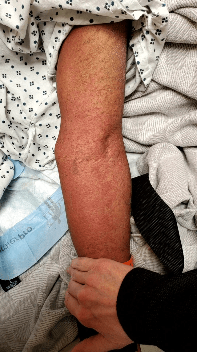 Cureus | Acute Immunoallergic Hepatitis in the Presence of Crohn’s ...