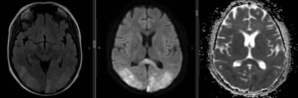 Posterior Reversible Encephalopathy Syndrome Radiology 461 Posterior