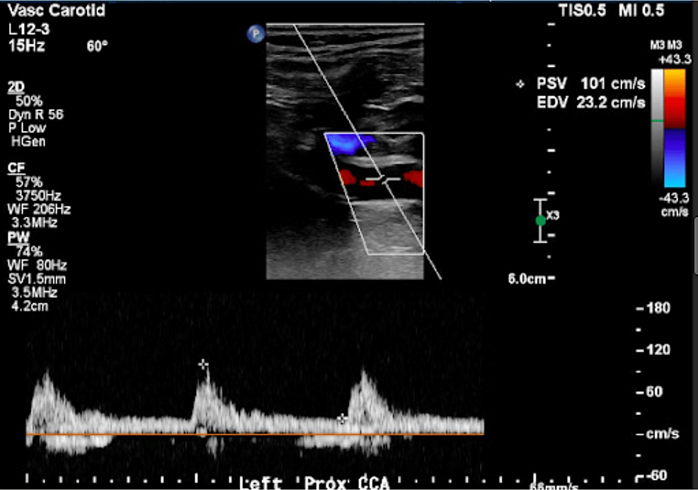Cureus | Transient Ischemic Attack Shakes: A Case Report