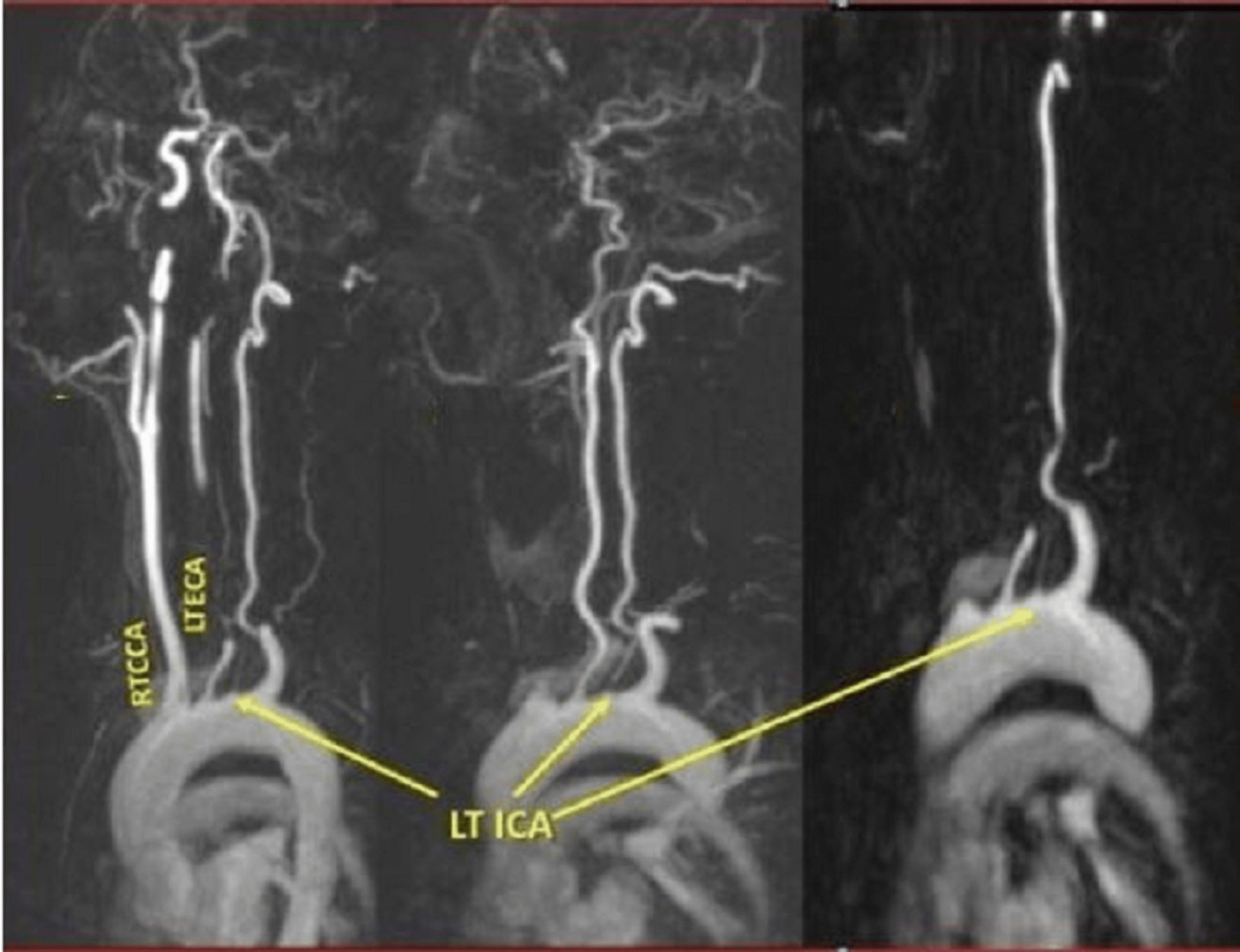 Left Common Carotid Artery Agenesis With Independent Origins of the ...