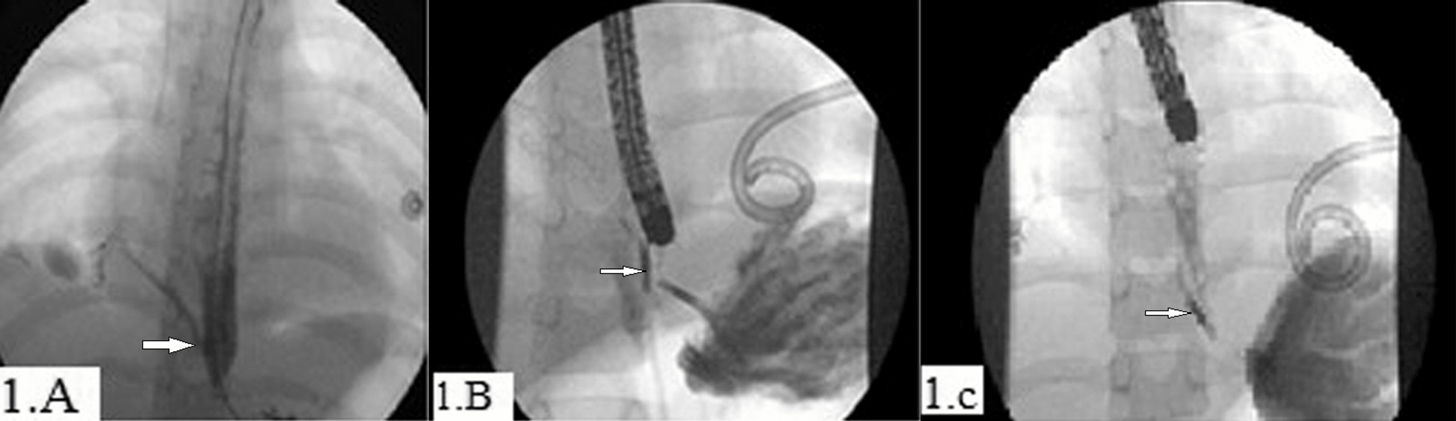 Cureus | Outcomes of Endoscopic Closure of Respiratory Esophageal ...