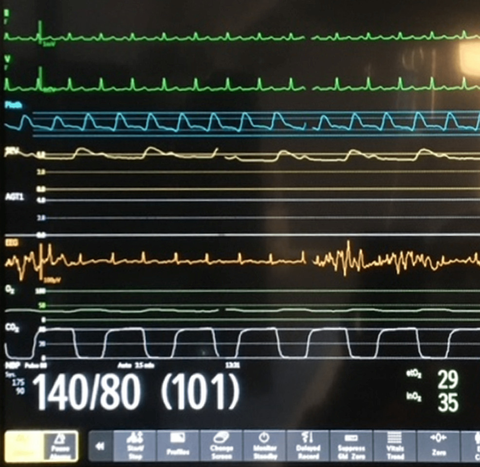 Electrocardiographic Interference on Bispectral Index Monitor: A Case ...