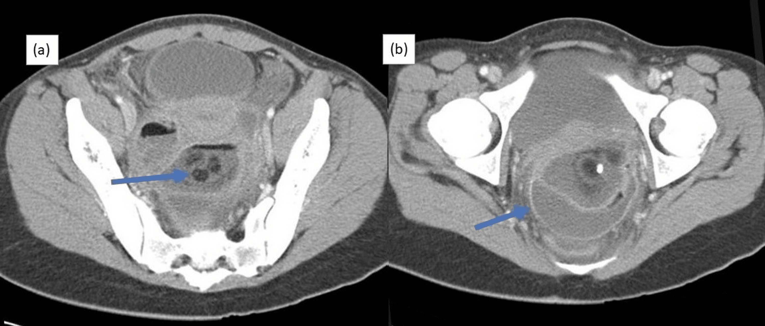 Dermoid Cyst Spillage Resulting in Chemical Peritonitis: A Case Report ...
