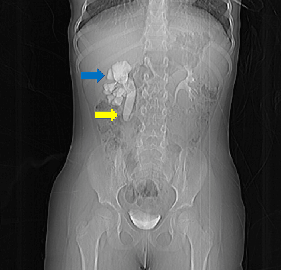 Cureus Pyeloplasty For A Child With A Retrocaval Ureter A Case Report Cureus Pyeloplasty For A Child With A Retrocaval Ureter A Case Report