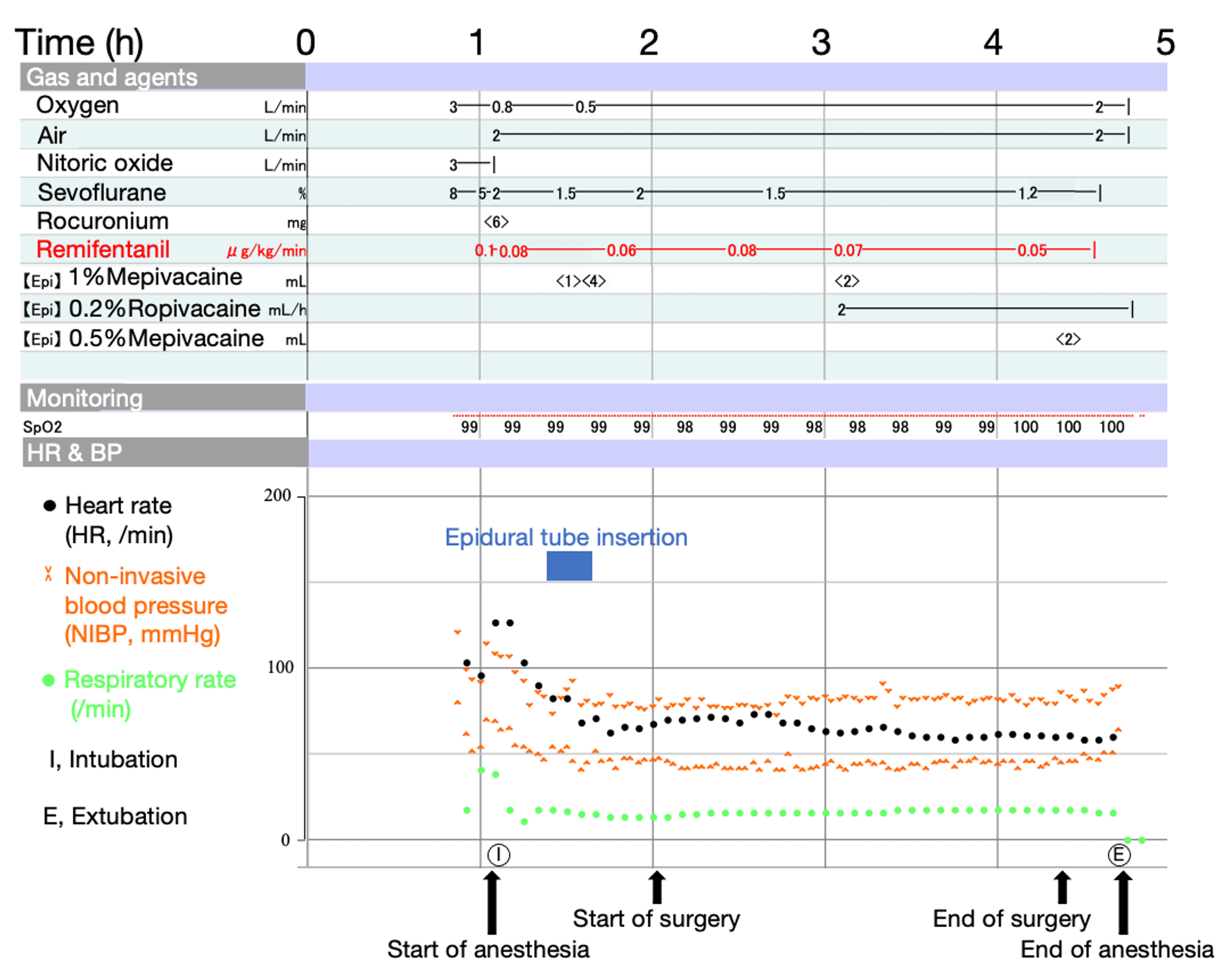 Breathing Labs Epidural Anesthesia And Continuous Epidural Analgesia 