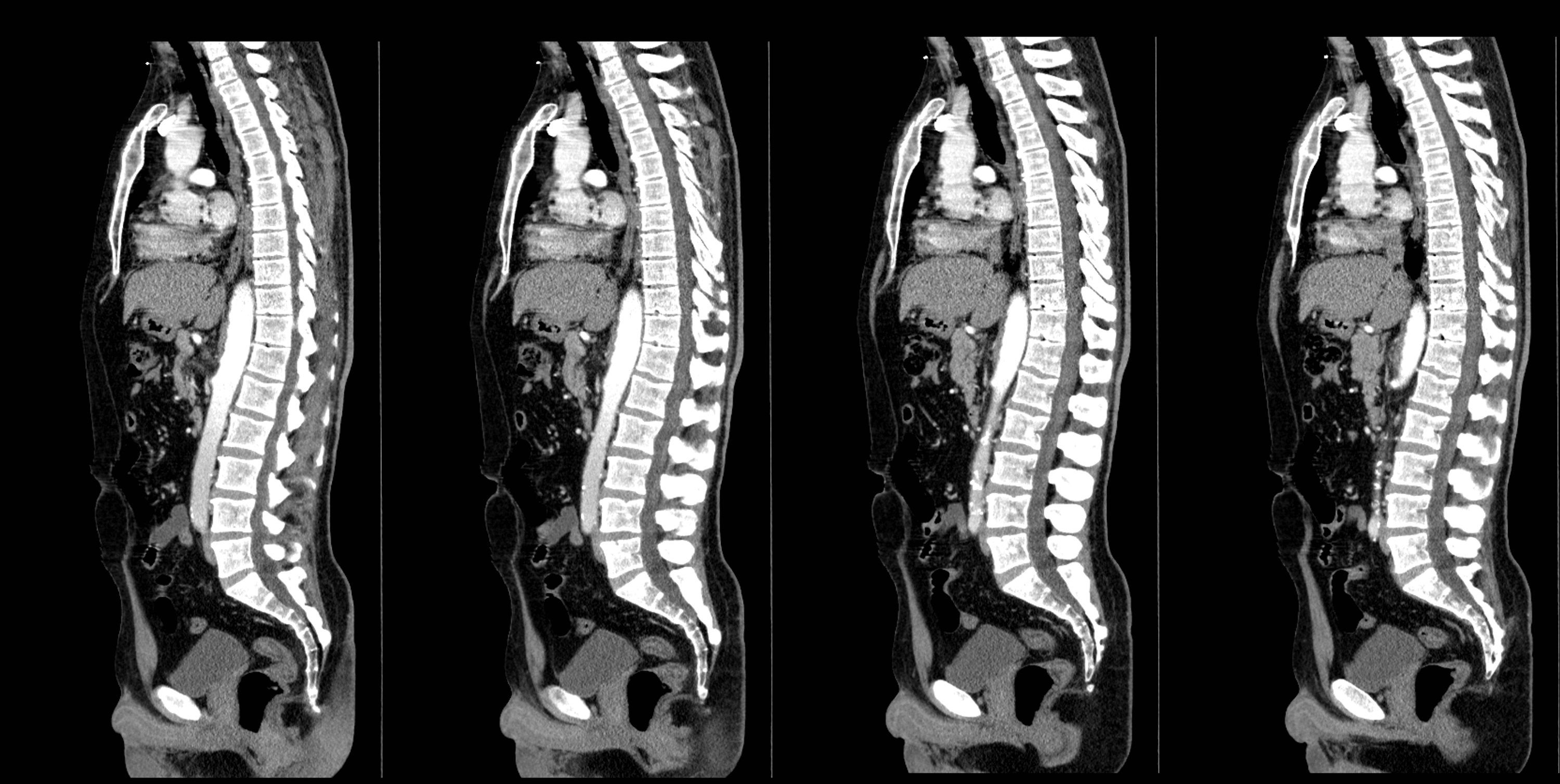 Cureus | Spinal Cord Infarction Presenting as Right-Sided Upper Back ...