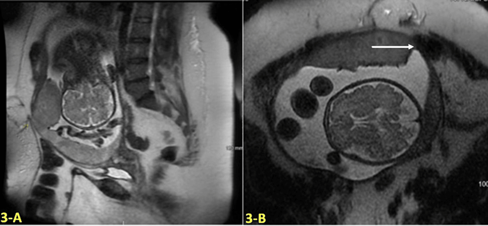 Cureus Sonographic Diagnosis And Management With Delayed Hysterectomy