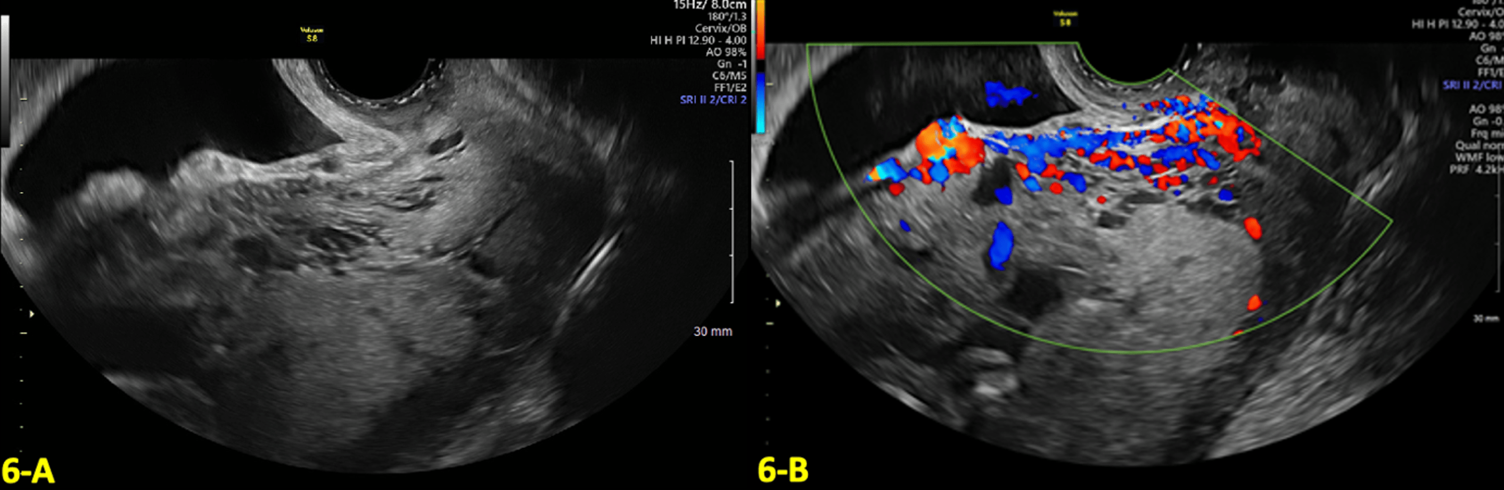 Cureus Sonographic Diagnosis And Management With Delayed Hysterectomy