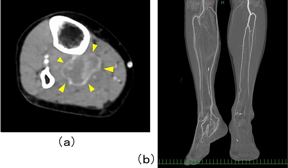 Cureus | Palliative Free Flap Surgery for Plantar Sarcoma: A Case ...
