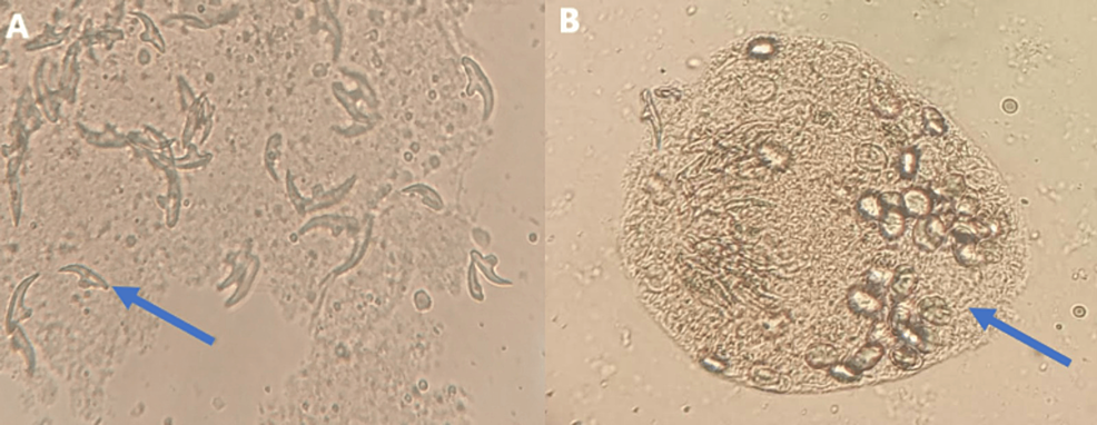 Cureus | Cardiac Echinococcosis With Hepatic Involvement in a Child: A ...