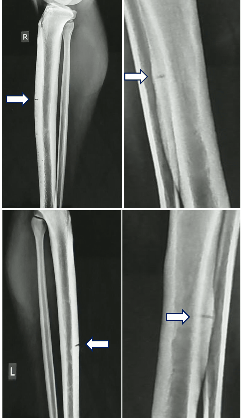 Lower Leg Stress Fracture Bone Lower Leg Stress Fracture Bone