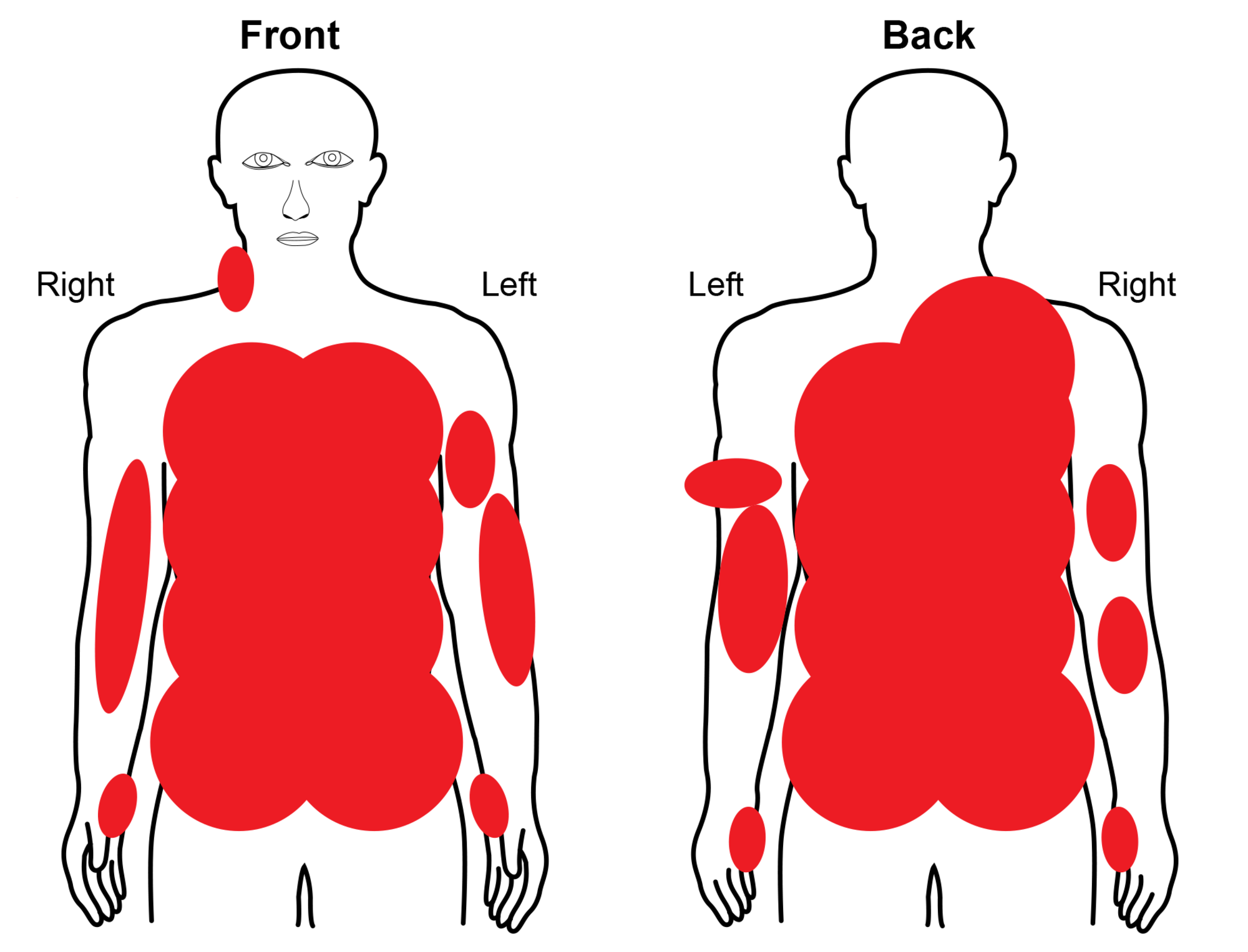 Negative Pressure Wound Therapy with Instillation and Dwell for the ...