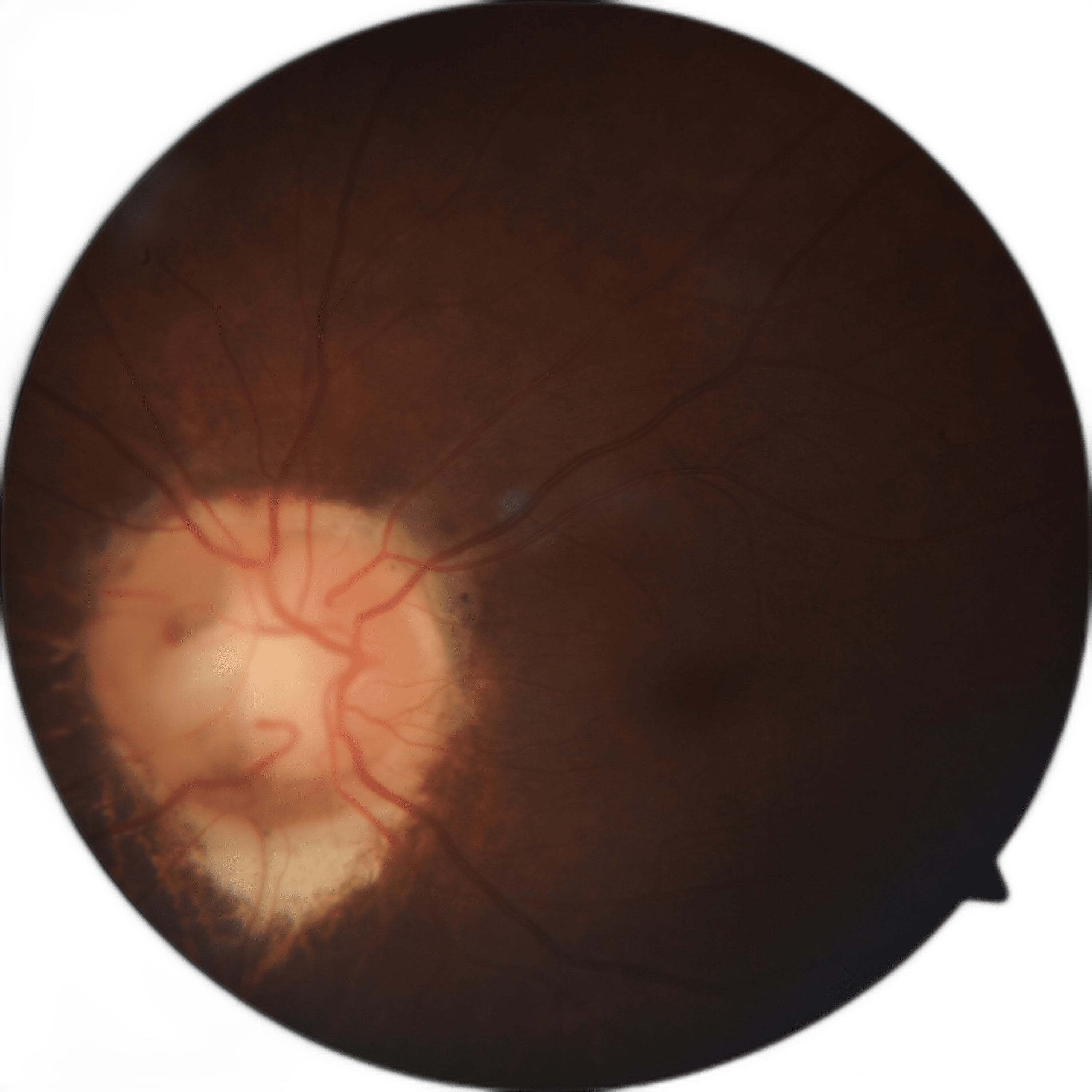 Confounder for Optic Disc Evaluation in Glaucoma | Cureus