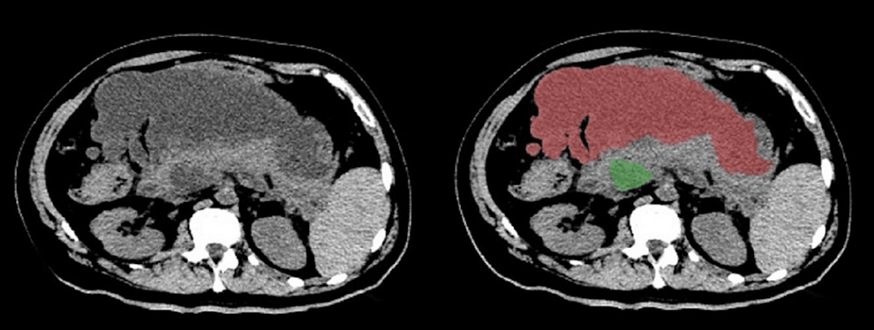 Cureus | Endoscopic Treatment of Complex Walled-Off Necrosis in ...