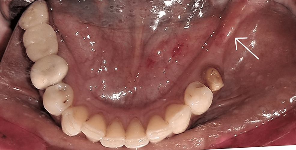 Mandibular Alveolar Ridge Split With Simultaneous Implant Placement: A ...