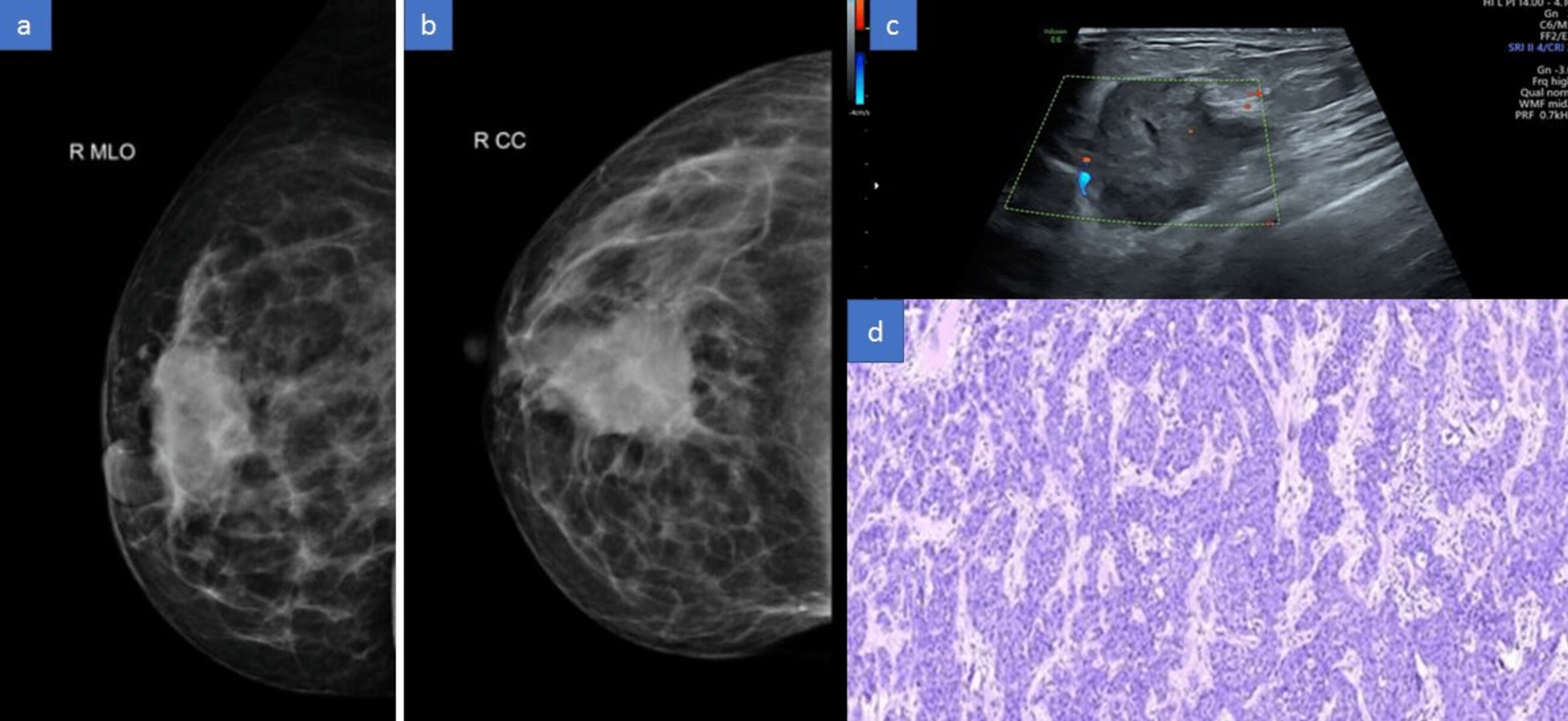 Cureus | Correlation of Mammography, Ultrasound and Sonoelastographic ...