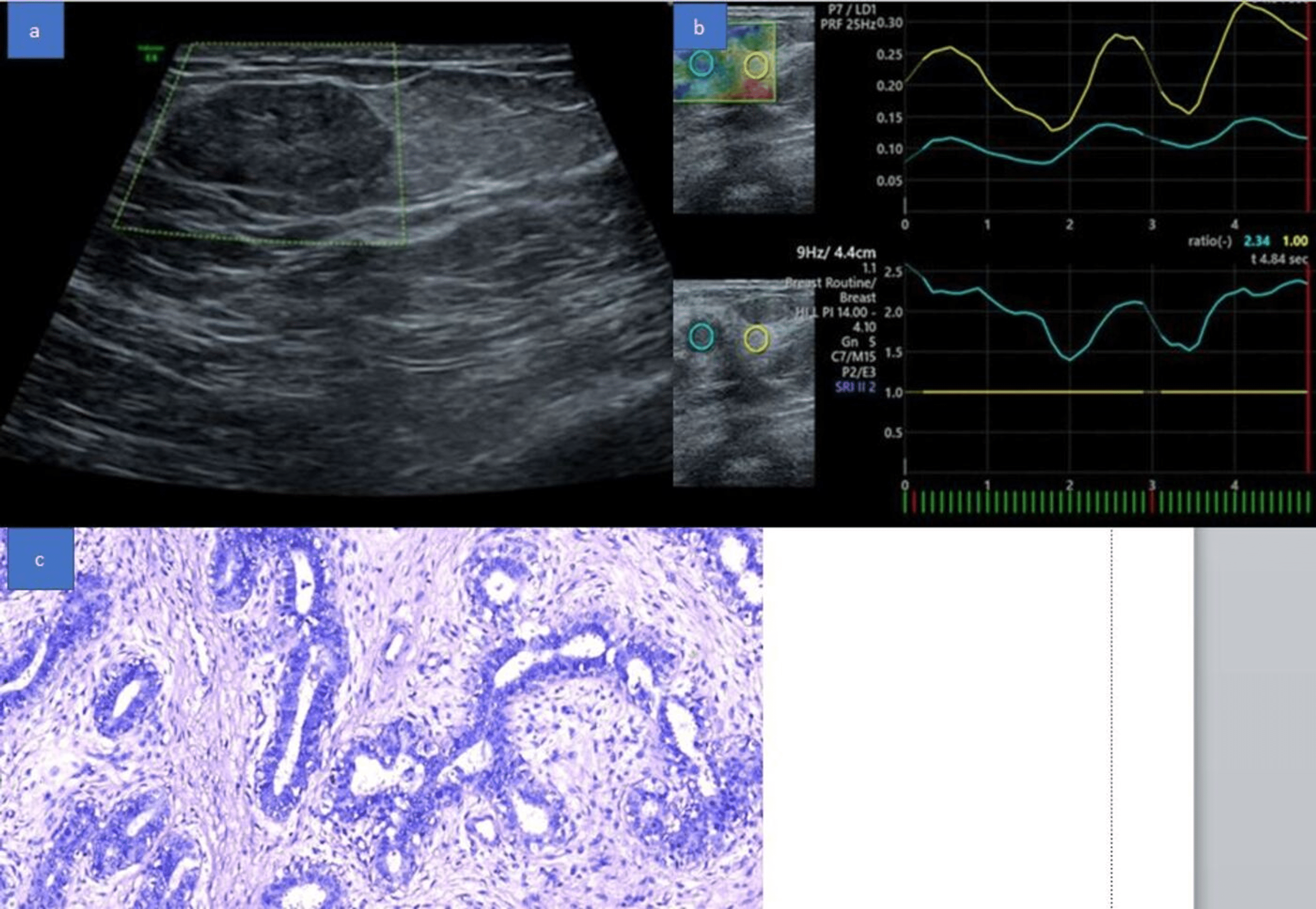 Cureus | Correlation of Mammography, Ultrasound and Sonoelastographic ...