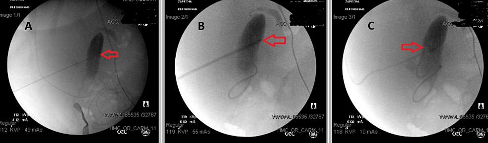 Minimally Invasive Ventriculo-Cholecystic Shunt Placement Utilizing ...