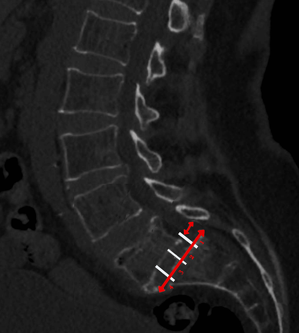 Spontaneous Fusion Of L5 S1 Spondylolisthesis In An Elderly Female A
