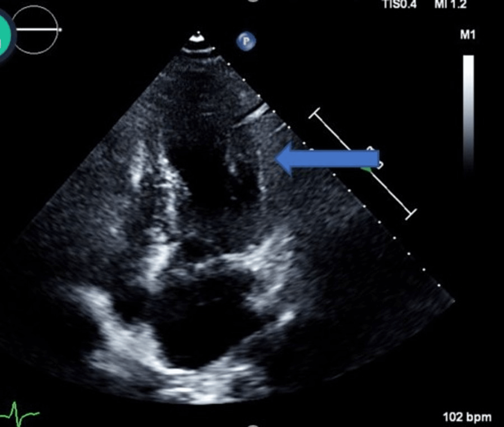 A Case Report of Takotsubo Cardiomyopathy With Myxedema Coma | Cureus