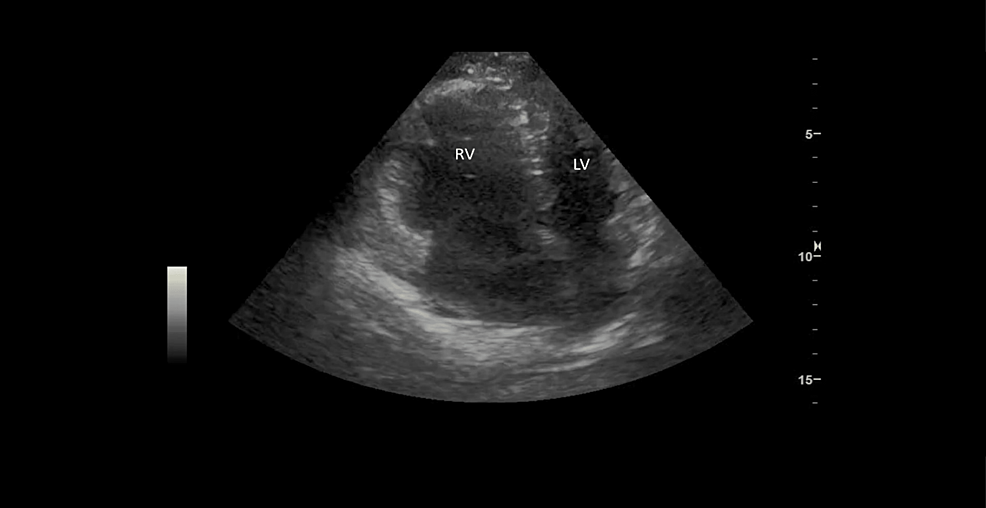 Cureus Bradycardia As A Rare Sign Of Pulmonary Embolism A Case