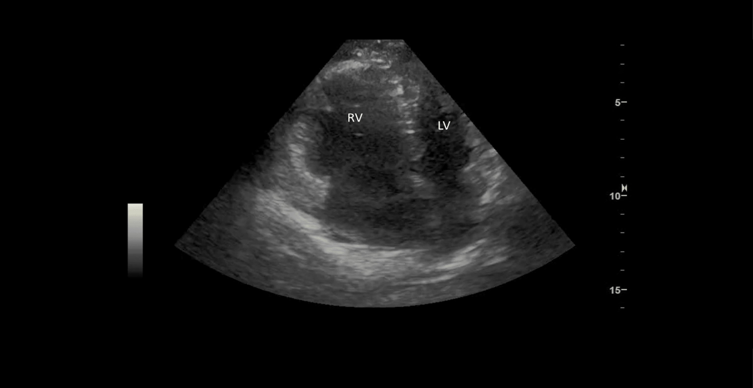Bradycardia As A Rare Sign Of Pulmonary Embolism A Case Report Of